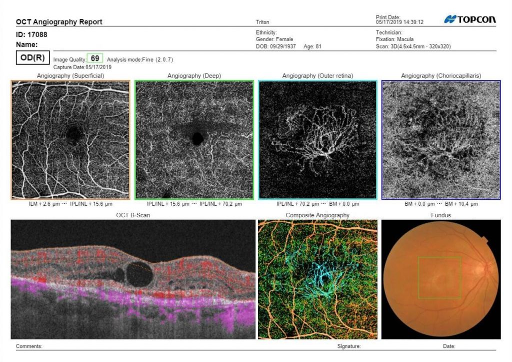 ANGIO OCT - Hospital de Olhos Videira